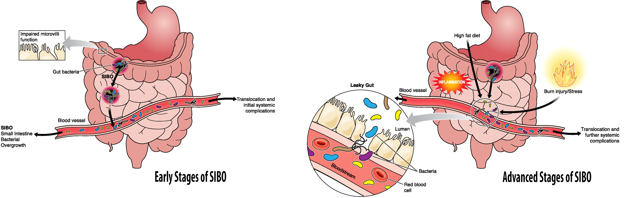 Understanding SIBO – My SIBO Recipes